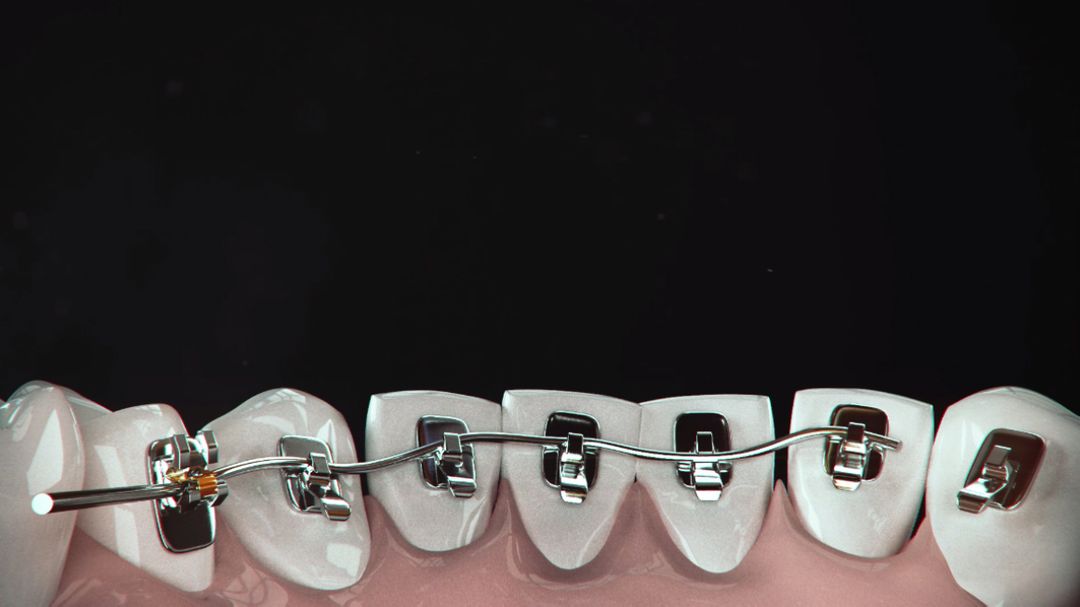 Dental Animation for Lingual Brace - CGHero